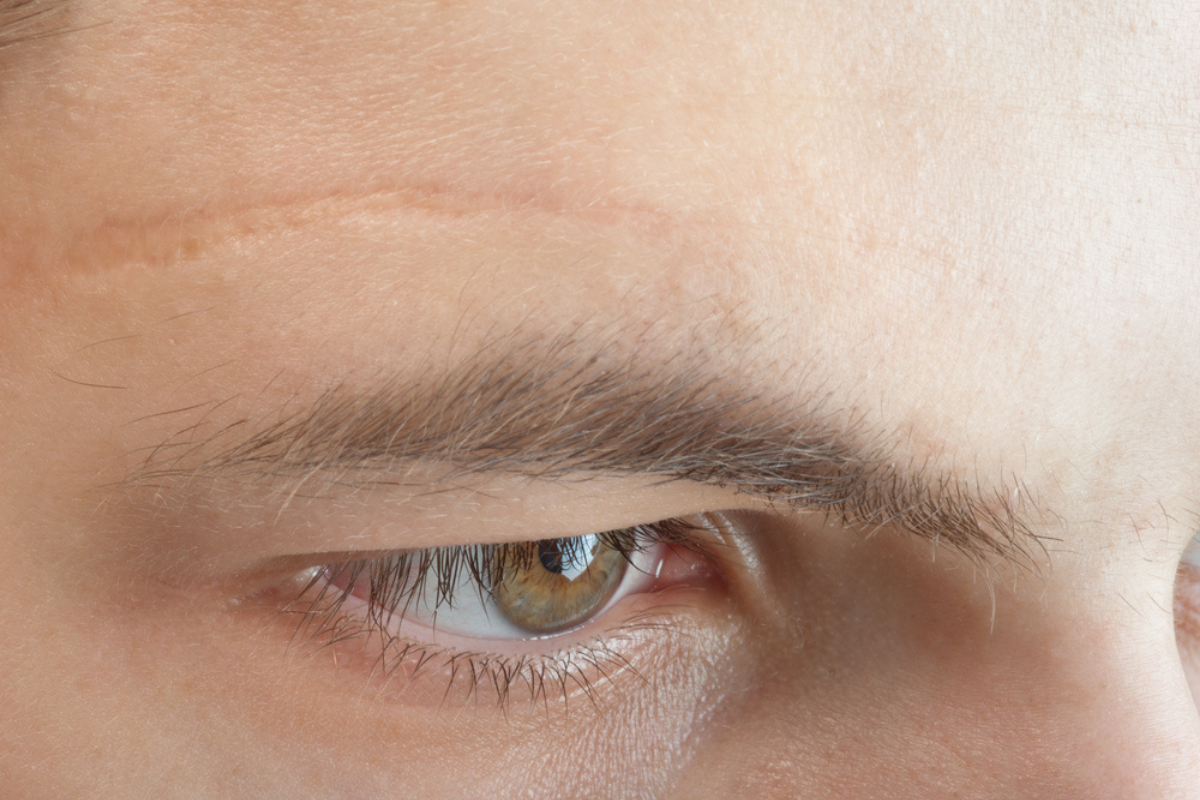 Scars: How Can I Get Rid of Them? – Sönd